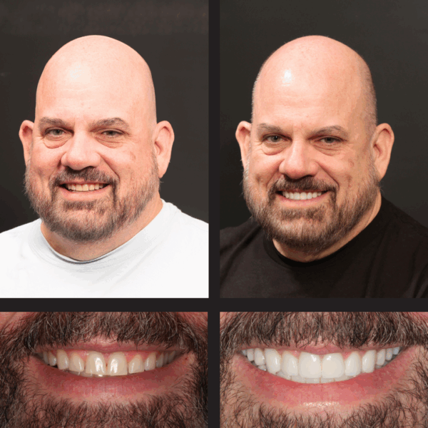 Smile Gallery - Rochester Advanced Dentistry