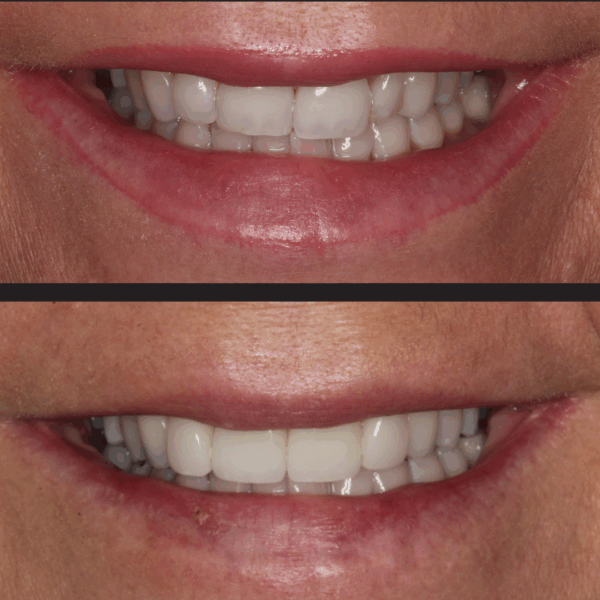 Smile Gallery - Rochester Advanced Dentistry