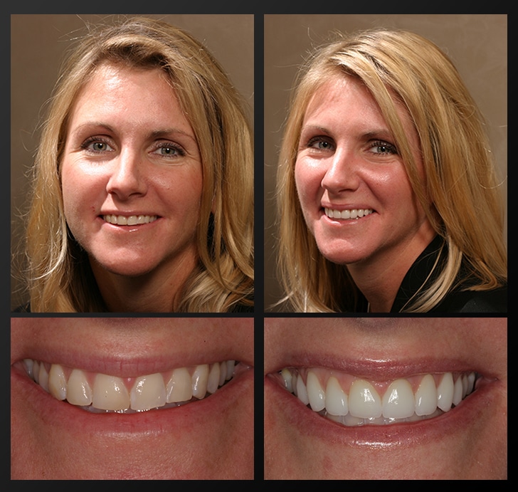 List 93 Pictures Teeth Whitening Before And After Full Face Superb