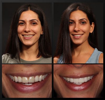 Smile Gallery | Dr. Jeff Haddad | Dr. Kurt Doolin | Rochester, MI