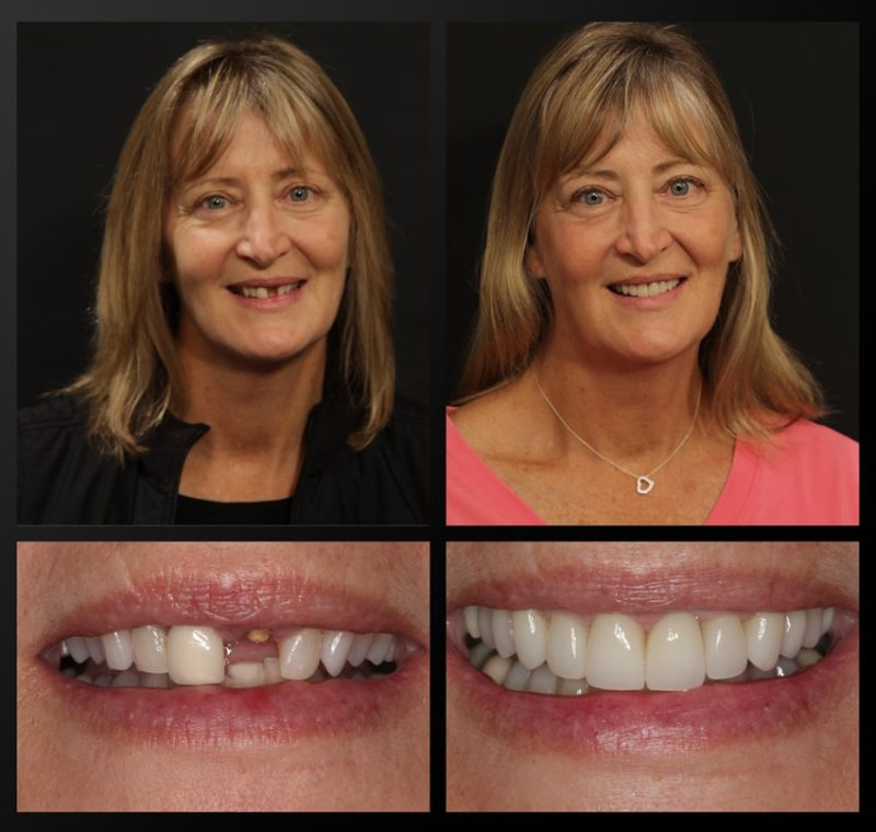 Smile Gallery | Dr. Jeff Haddad | Dr. Kurt Doolin | Rochester, MI